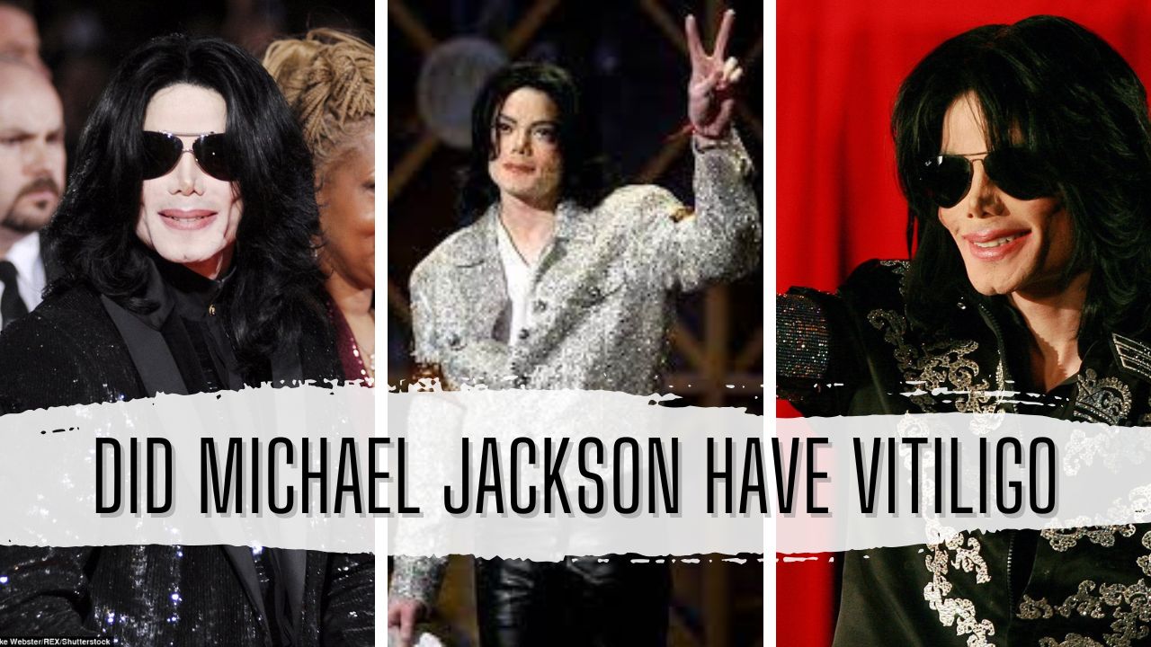 Did Michael Jackson Have Vitiligo? Unveiling the Truth Behind the King of Pop’s Skin Condition ...